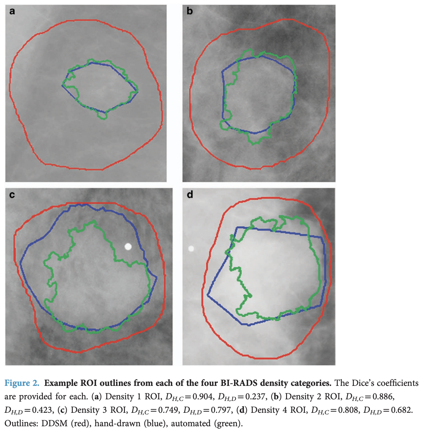 CBIS-DDSM Mammography Dataset - Notes by Lex